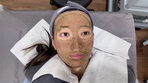 알라딘 필링 일주일 후기🥵 여드름 없애는 방법🧡 알라딘필링 통증 가격 다 알려드려요 Youtube