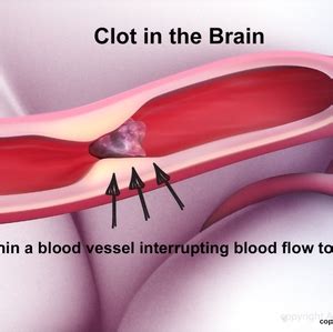 Aha Asa Medical Graphics And Illustrations American Heart Association