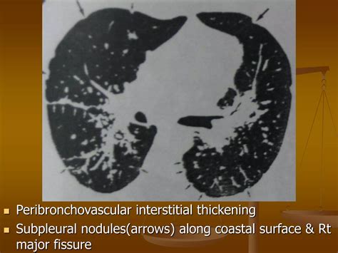 Sarcoidosis Radiology Pulmonary Neuro Abdominal Ppt