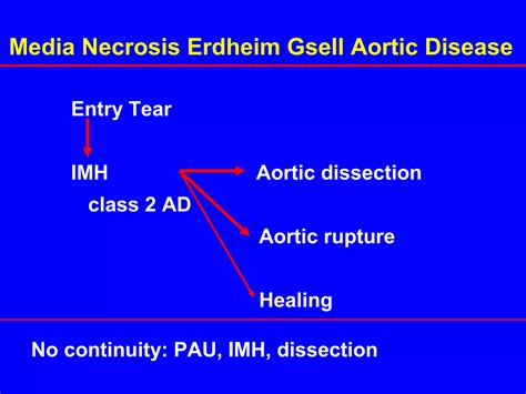 Aortic Ulcer Intramural Hematoma Aortic Dissection Ppt