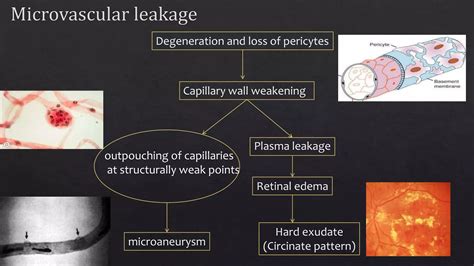 Pathophysiology Of Diabetic Retinopathy Pptx