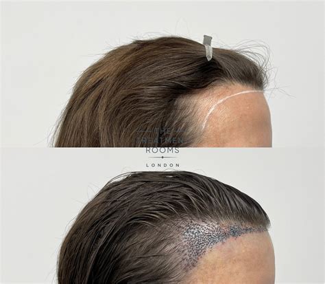 Hair Transplant Surgery Archives Treatment Rooms London Hair Transplant Surgery Archives Treatment Rooms London