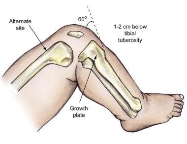 Proximal Tibia Io