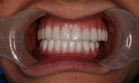 Full Arch Fixed Implant Bridge Before And After Photos Boardman Ohio