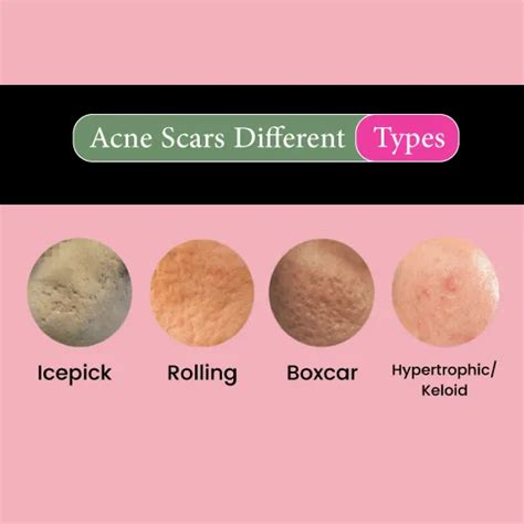 Acne Scars Treatment In Multan Get Smooth Skin