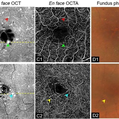 Microaneurysms Visualized By Oct Octa Fundus Photography Fp And Download Scientific Diagram