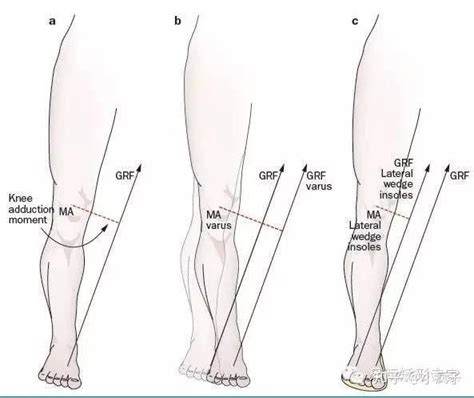 儿童八字脚走路的原因分析以及矫正应对策略介绍 知乎