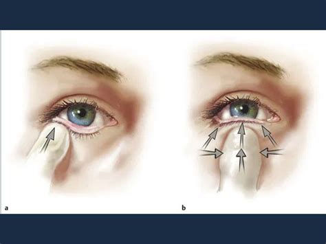 Eyelid Malpositions Surgery And Treatment In Woodville Adelaide