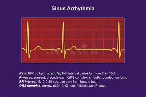 Sinus Arrhythmia