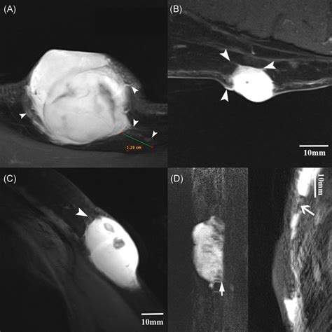 Specific Features Of Dermatofibrosarcoma Protuberans Dfsp Download Scientific Diagram