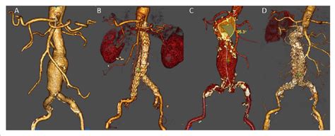 Preoperative And Postoperative Computed Tomography Ct Scan With A 3d