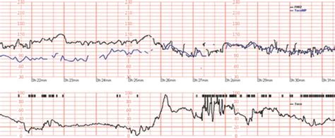 Uterine Contractions Obgyn Key
