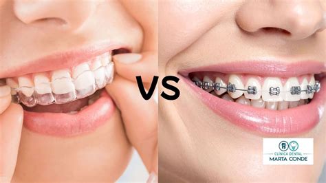 Invisalign Vs Brackets Metálicos Clínica Dental Marta Conde