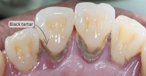 Black Between Teeth And Gums How To Fix Black Triangles Share