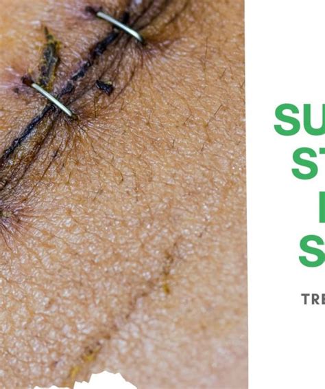 Surgery Scars Archives Treat Your Scars