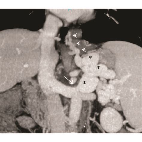 The Kiyosue Classification Of Gastric Varices A Classification Based