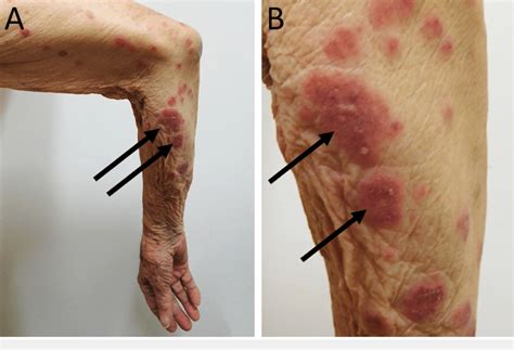 Bullous Leukocytoclastic Vasculitis