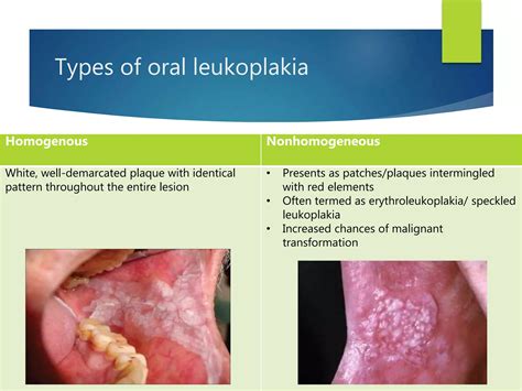 Oral Mucosal Lesions Pptx