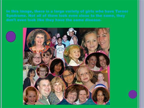 Ppt Turner Syndrome Powerpoint Presentation Free Download Id2876758
