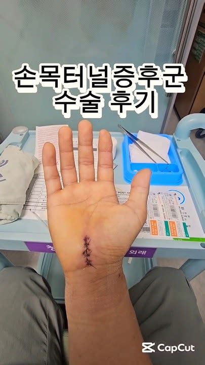 손목터널증후군 수술후기 수술해도 재발 Youtube 손목터널증후군 수술후기 수술해도 재발 Youtube