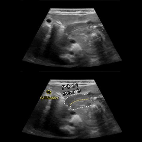 Ultrasound Pocus Hypertrophic Pyloric Stenosis Daniel Ben Mordechay