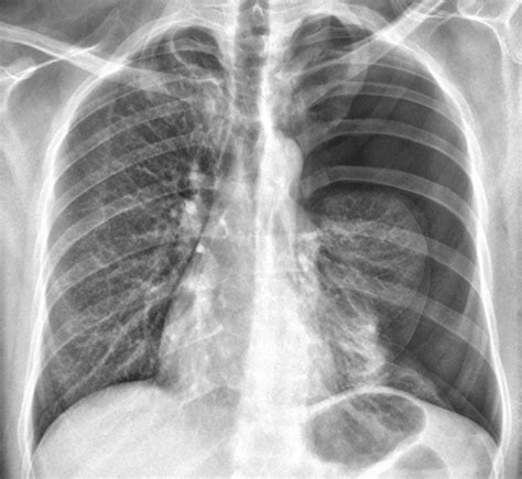 Chest X Ray Pneumothorax Radrounds Radiology Network