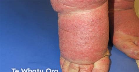 Acute Lipodermatosclerosis Image