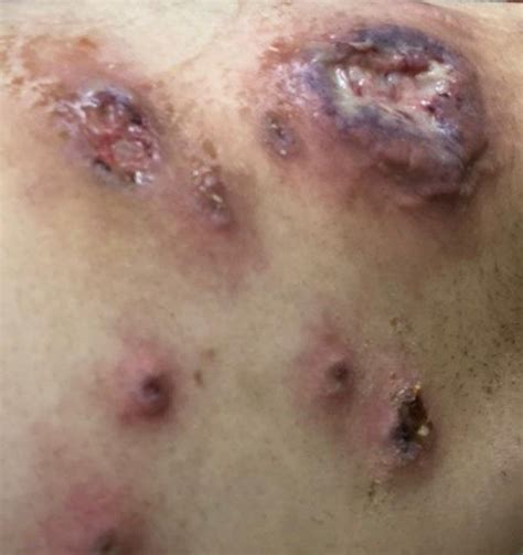 Dramatic Response Of Rapid Progressive Atypical Pyoderma Gangrenosum To Infliximab In A Patient