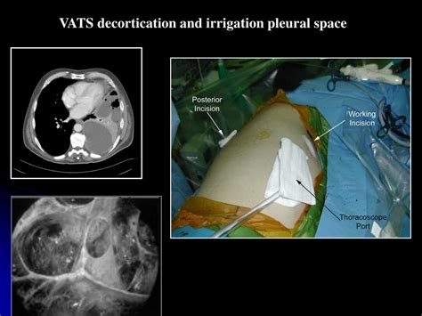 Ppt Pleural Empyema Powerpoint Presentation Free Download Id5735694