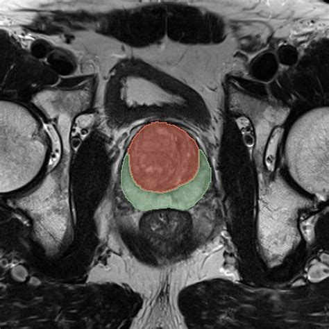 Hevi Ai Prostate Zonal Segmentation Algorithms Grand Challenge