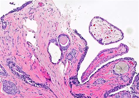 Pathology Outlines Urethral Polyp
