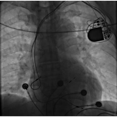 A Chest X Ray Shows The Position Of The Pacemaker And Electrode Download Scientific Diagram