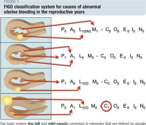 Figure 1 From The Figo Systems For Nomenclature And Classification Of Causes Of Abnormal Uterine