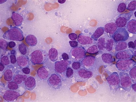 Autoimmune T Cell Lymphoma At Mary Mckeehan Blog