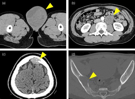 Successful Management Of Testicular Primitive Neuroectodermal Tumor With Multiple Bone