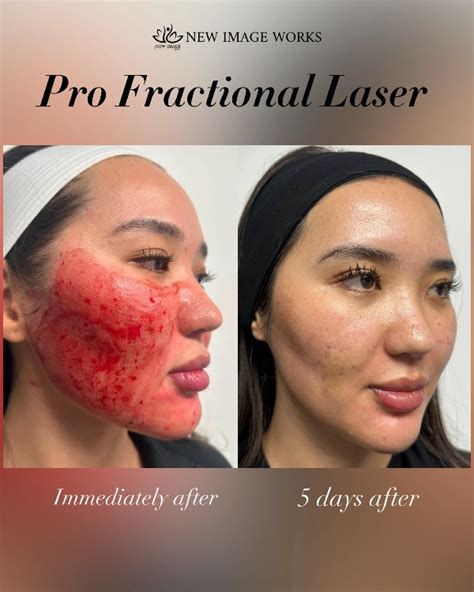 Profractional Laser Acne Scar And Scar Revision Solution