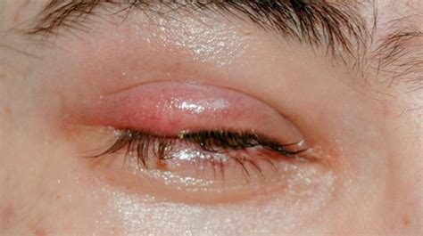 Infections Of The Eye Causes Symptoms Treatment And More