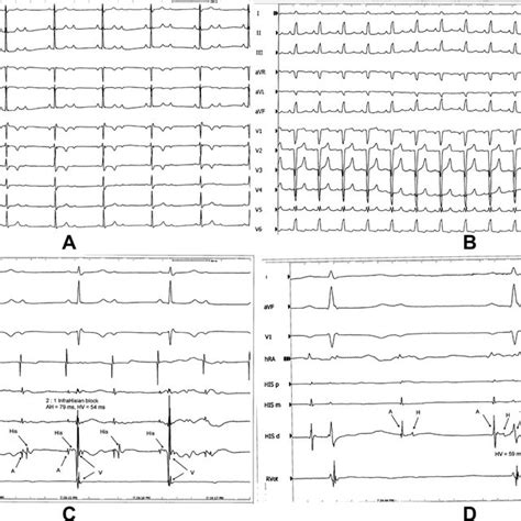 Pdf Nodal And Infranodal Atrioventricular Conduction Block Electrophysiological Basis To