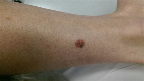 Fundraiser By Diana Leah Kick Melanomas Butt