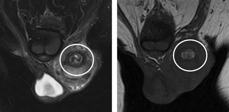 Mri Of Patients With Suspected Scrotal Or Testicular Lesions