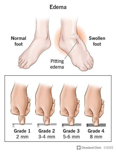 Edema Medizzy