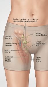 Swollen Lymph Nodes In Groin Female Pictures A Visual Guide