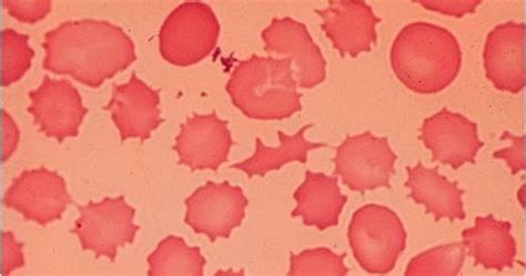 AMIGOS PARA SIEMPRE MORFOLOGÍA ANORMAL DE LOS ERITROCITOS