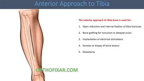 Anterior Approach To Tibia Easily Explained Orthofixar