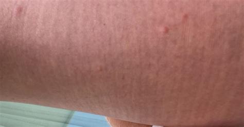 Itchy Leg