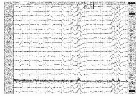 Eeg In The Newborn Infant And Adolescent Neupsy Key