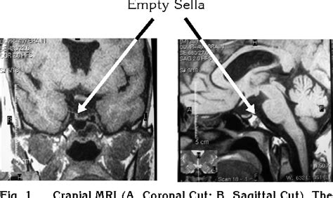 Figure 1 From Primary Empty Sella With Partial Hypopituitarism And