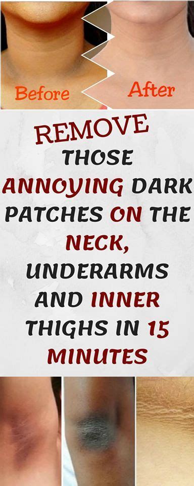 Remove Those Annoying Dark Patches On The Neck Underarms And Inner Thighs In Minutes Bea