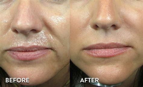 Atlanta Skin Care Clinic Rejuvenation And Resurfacing Treatments