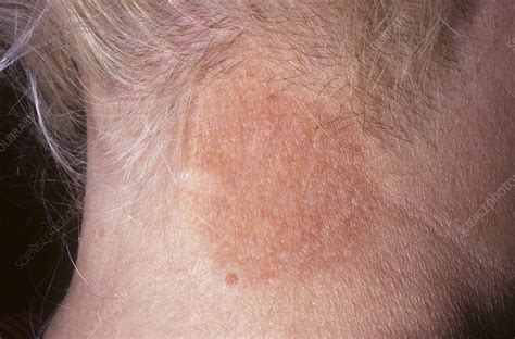 Lichenoid Skin Lesion Stock Image C0402240 Science Photo Library